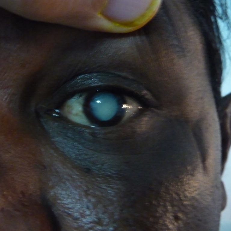 White Cataract : To Operate or NOT to Operate, That is the Question ...